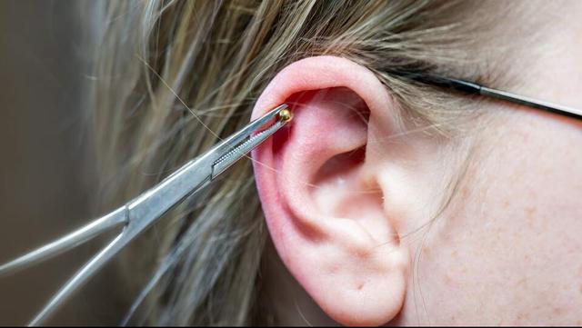 Al ruim 150 meldingen van ontstoken oren door zoutspray LM Piercings ...